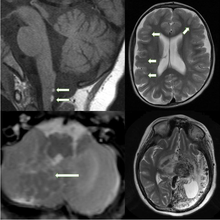 Neuroimaging manifestations of epidermal nevus syndrome