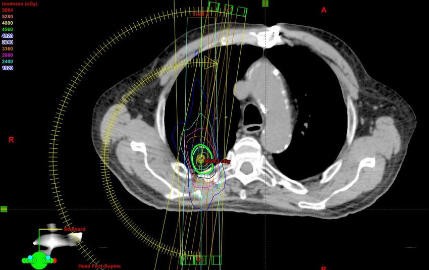 SBRT-Early Stage Non Small Cell Lung Cancer SRS for Brain Metastases ...