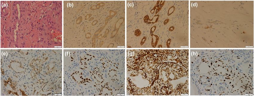 Mediastinal mixed germ cell tumor: A case report and literature review ...