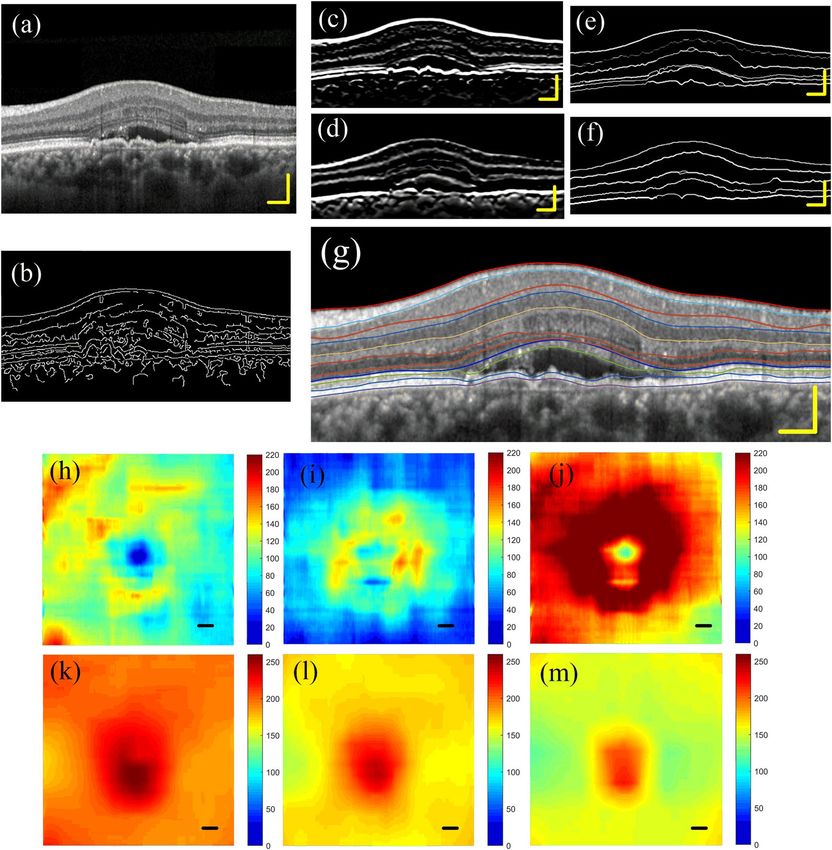 Automated retinal boundary segmentation of optical coherence tomography ... Automated retinal boundary segmentation of optical coherence tomography ...