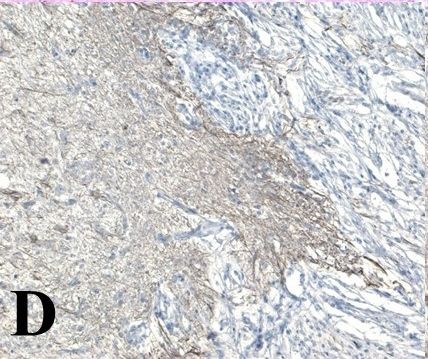 Benign ovarian teratoma in the dog with predominantly nervous tissue: A ...