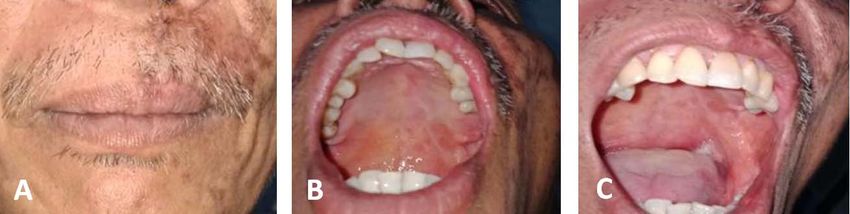 Dilemma in Diagnosing Herpes Zoster with Prodromal Odontalgia in ...