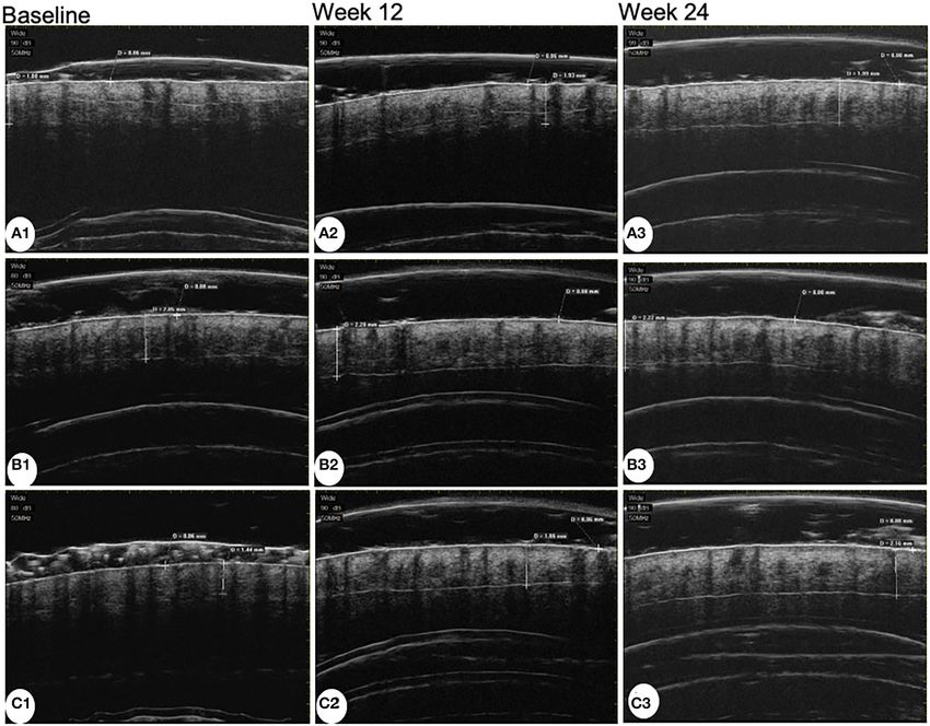 Efficacy And Safety Of 5 Minoxidil Alone Minoxidil Plus Oral