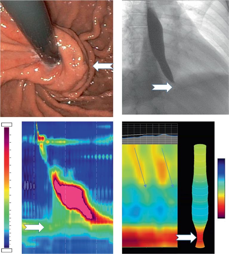 Complications of antireflux surgery