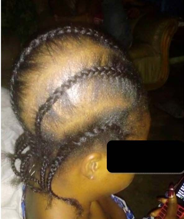 Giant Lipoma of the Scalp in Aba, South East Nigeria: A Case Report