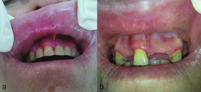 Lichenoid lesions of the upper lip: A retrospective study of 24 cases