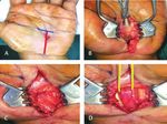 Analysis of the Long-Term Outcome in Open Carpal Tunnel Release ...