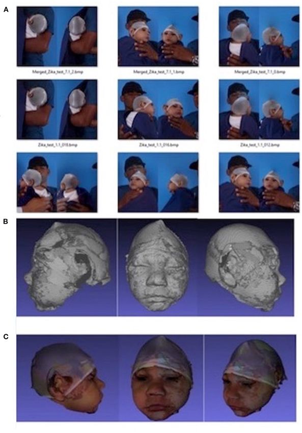 The Characterisation of the Craniofacial Morphology of Infants Born ...