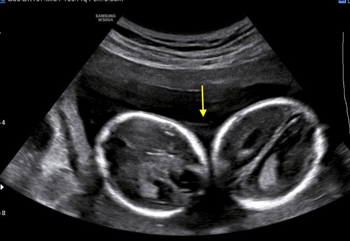 Monochorionic Diamniotic Twin Pregnancy Complicated By Spontaneous