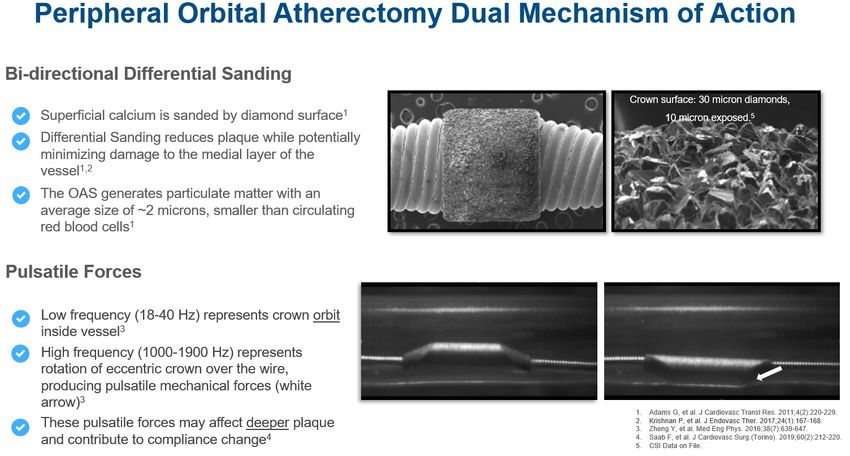 Orbital Atherectomy Treatment of Peripheral Artery Disease and Critical ...