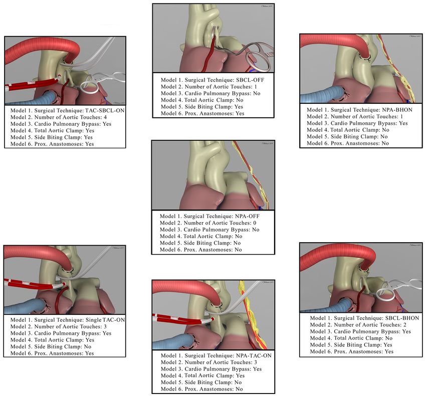 Surgical Risk Factors For Ischemic Stroke Following Coronary Artery surgical-risk-factors-for-ischemic-stroke-following-coronary-artery