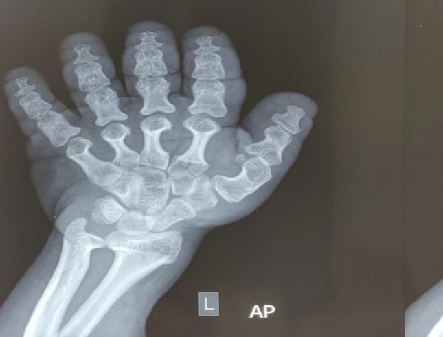 Achondroplasia A Case Report And The Review Of The Basics