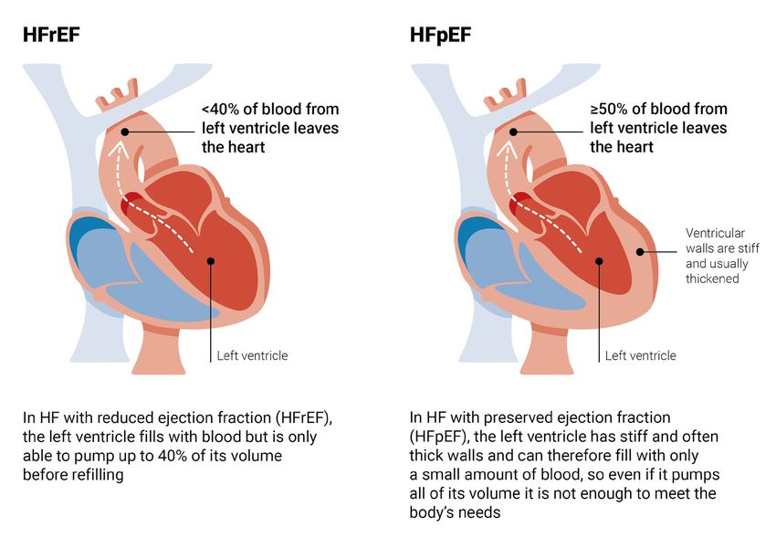 SPOTLIGHT ON HFPEF: HEART FAILURE WITH PRESERVED EJECTION FRACTION SPOTLIGHT ON HFPEF: HEART FAILURE WITH PRESERVED EJECTION FRACTION