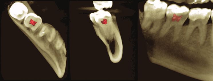 The Coronal Pulp Cavity Index an aid in age determination -A Cone Beam ...