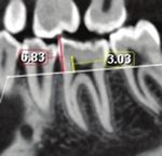 The Coronal Pulp Cavity Index an aid in age determination -A Cone Beam ...